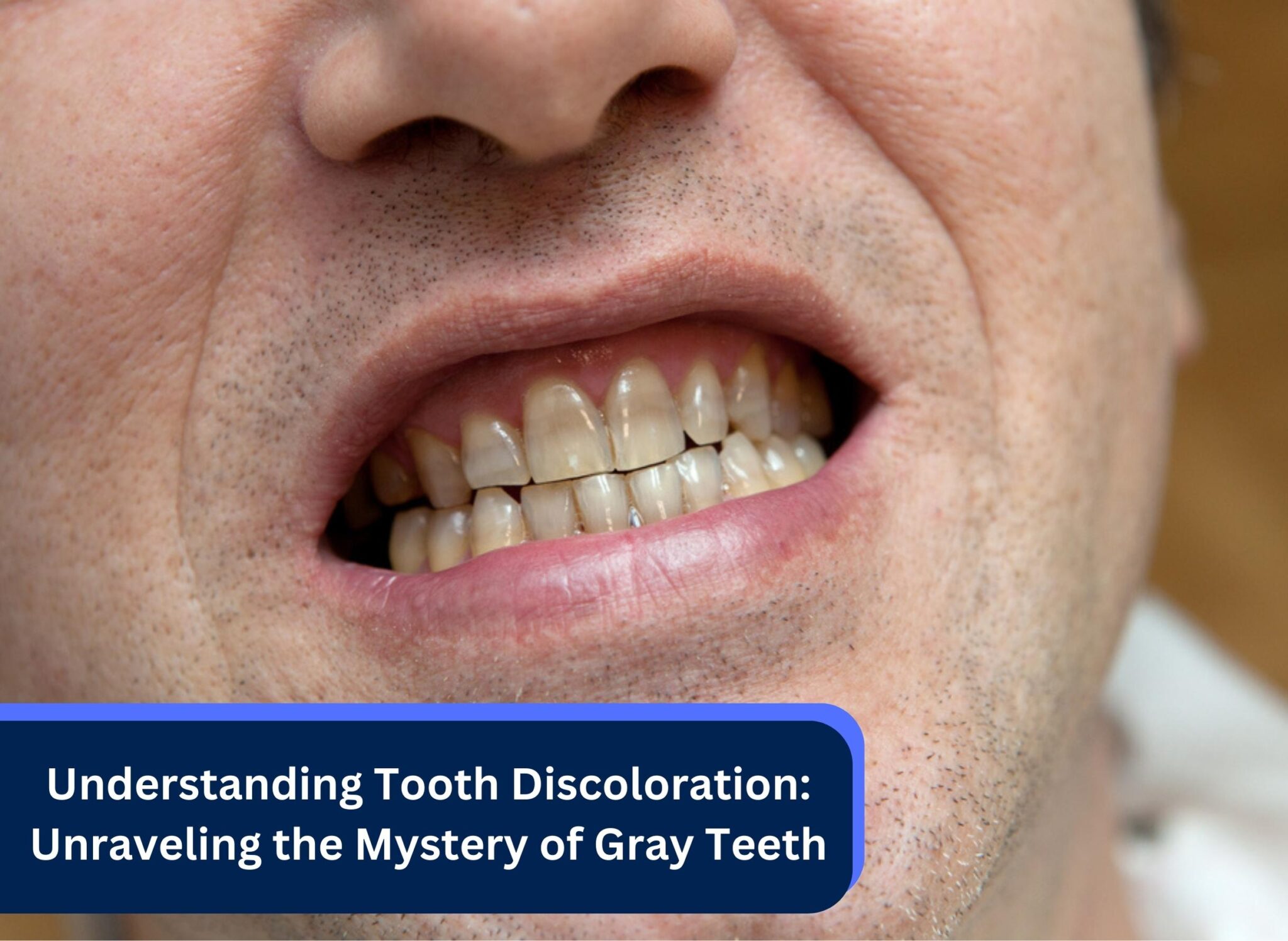 Understanding Tooth Discoloration: Unraveling the Mystery of Gray Teeth