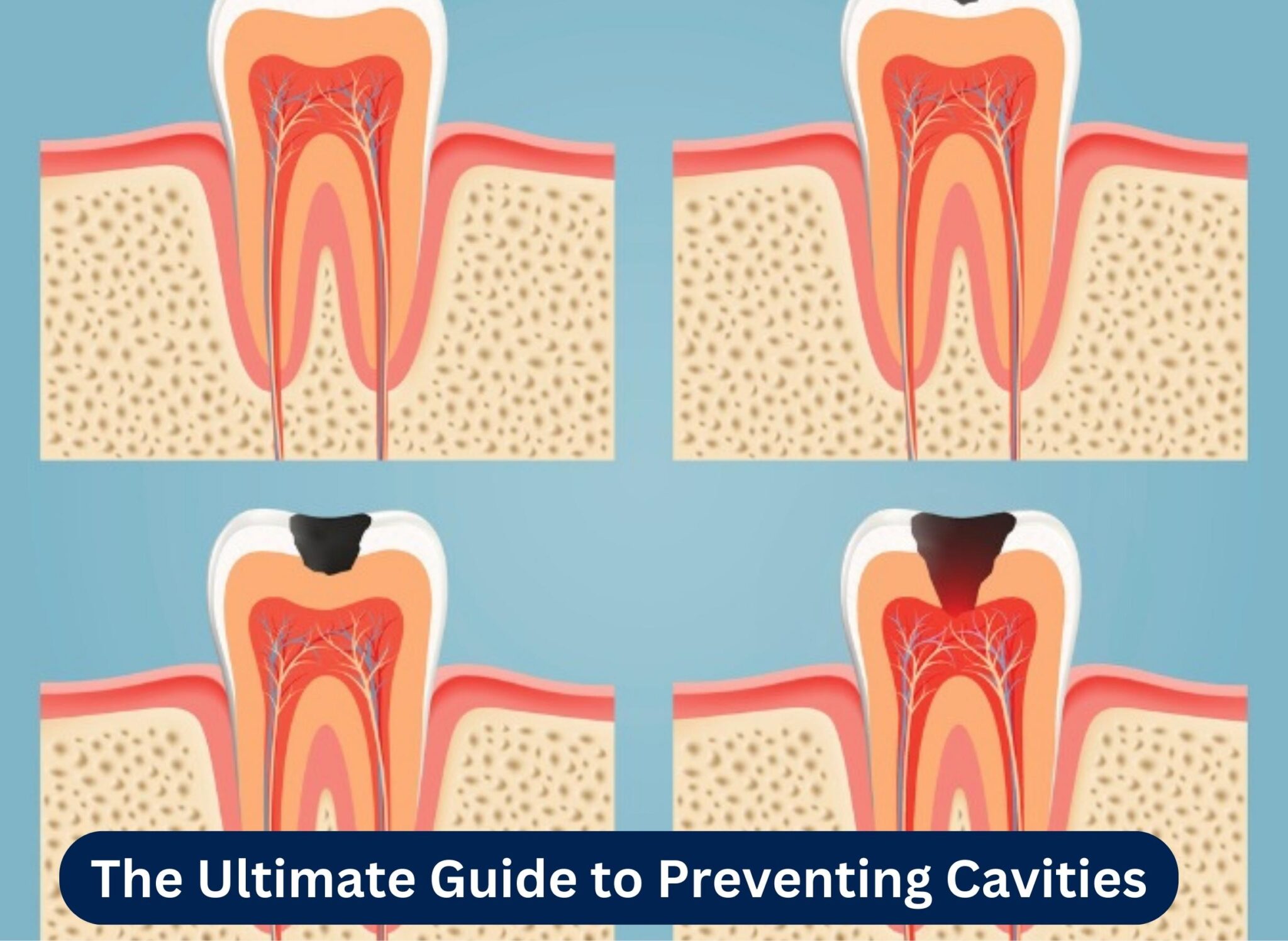 The Ultimate Guide to Preventing Cavities